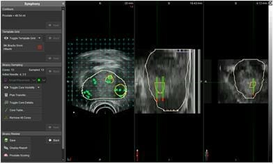 MRI Fusion Guided biopsies of the prostate and MRI-HIFU focal therapy ...